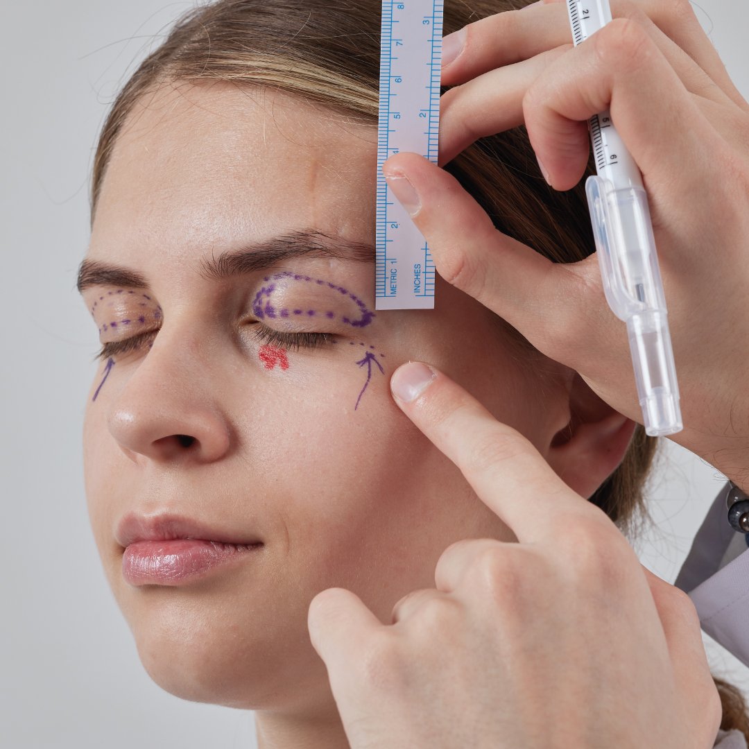 Blepharoplasty (Eyelid Surgery) Turkey - Yaman Surgery