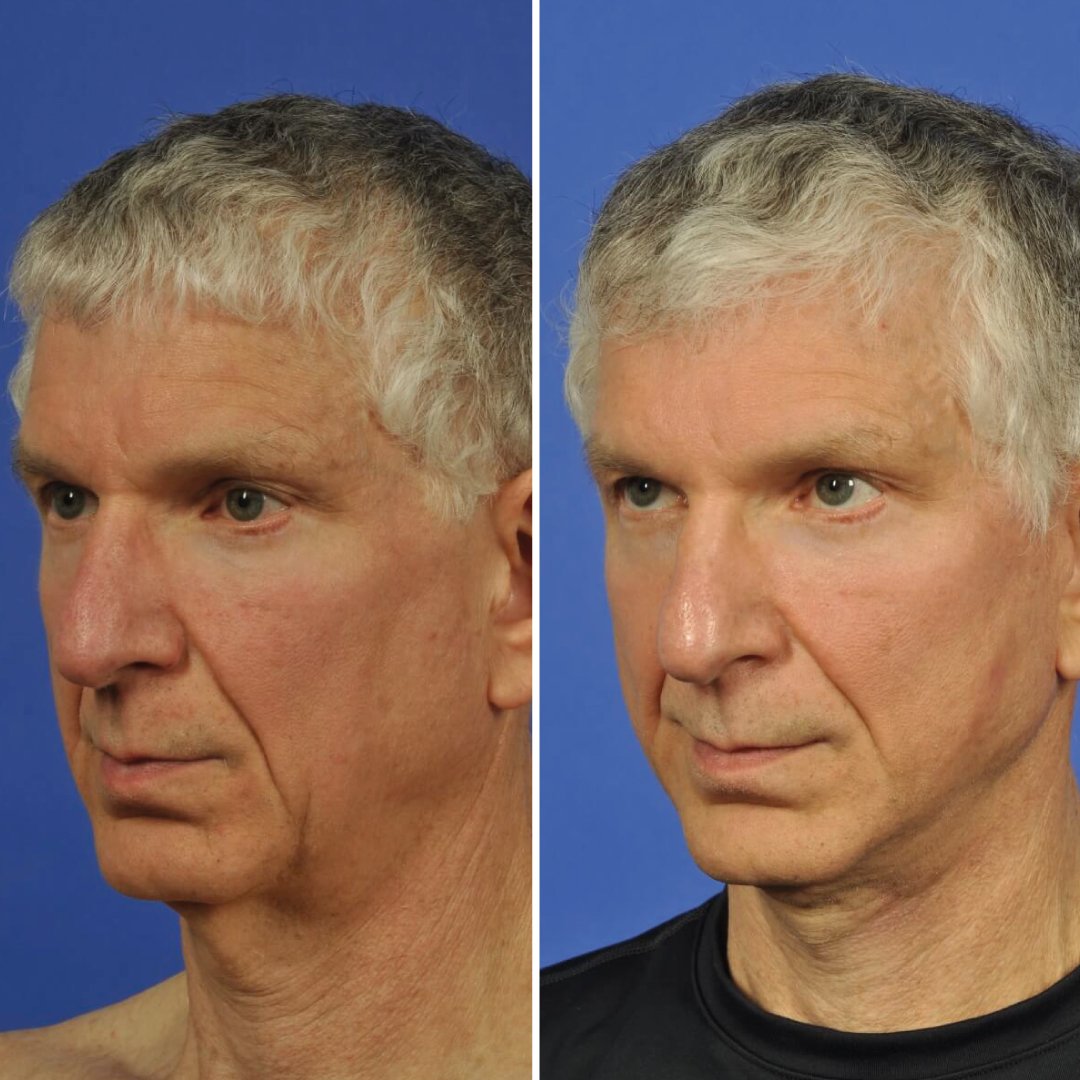 Facelift Turkey - Yaman Surgery