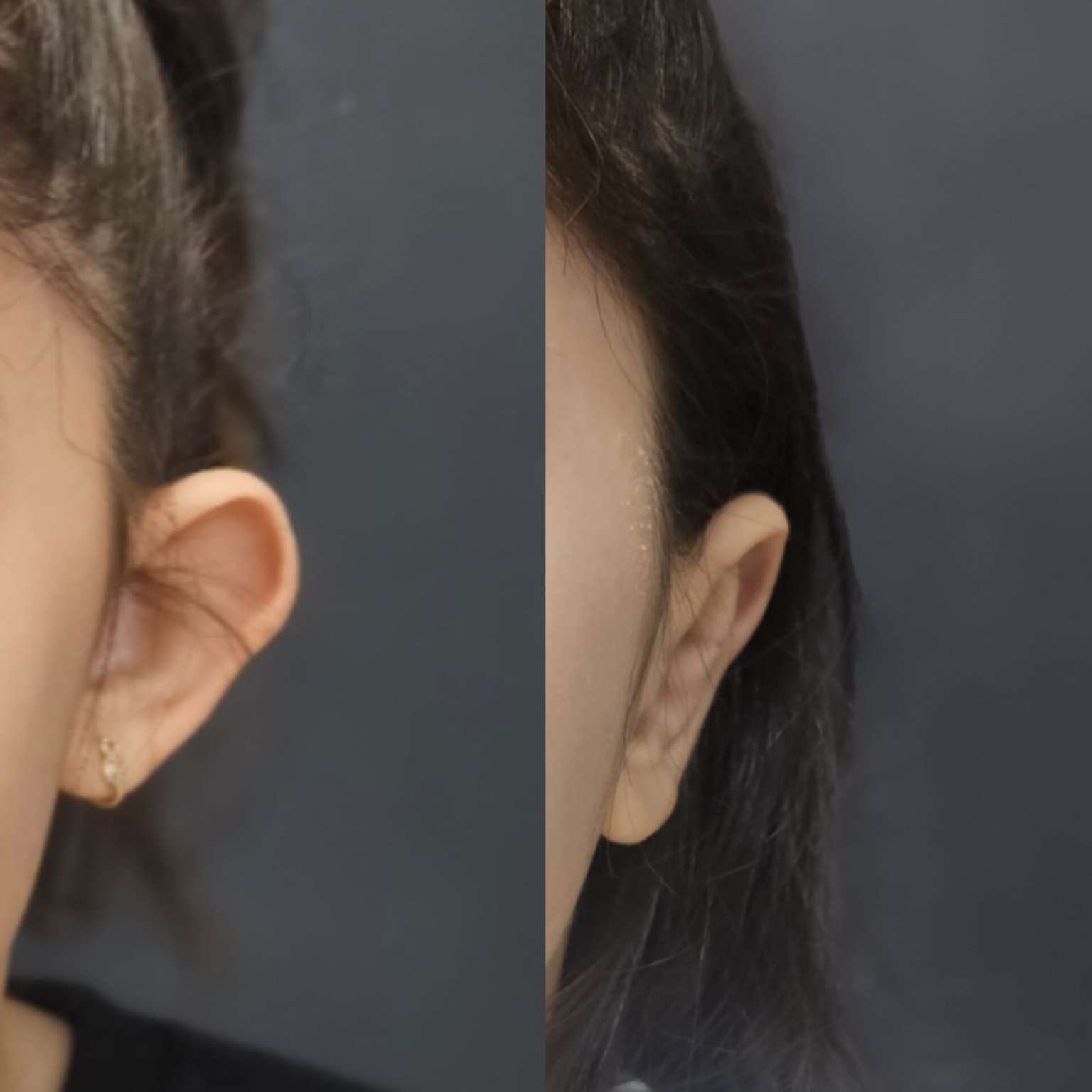 Ear Pinning Surgery in Turkey: Your All Questions Answered - Yaman Surgery