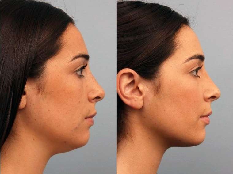 What is Double Chin Surgery or Double Chin Removal? - Yaman Surgery